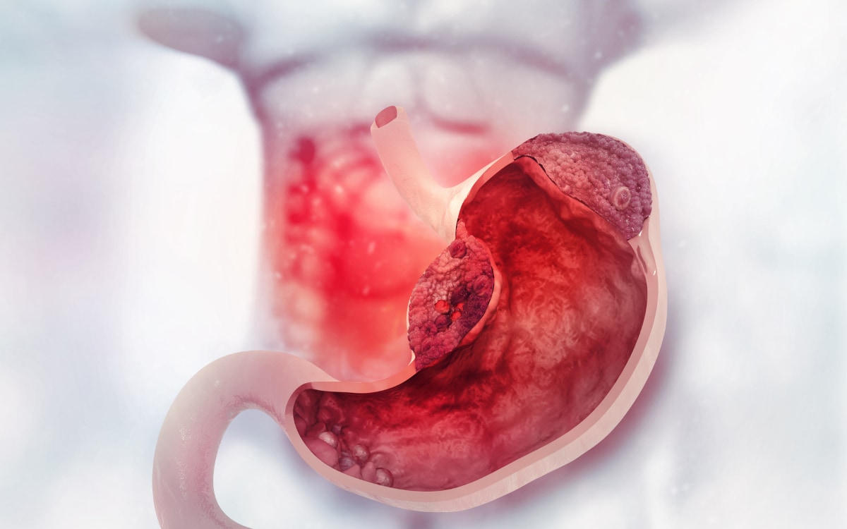 Sconfiggere l'Acidità di Stomaco: 10 Rimedi Efficaci per Ritrovare ...