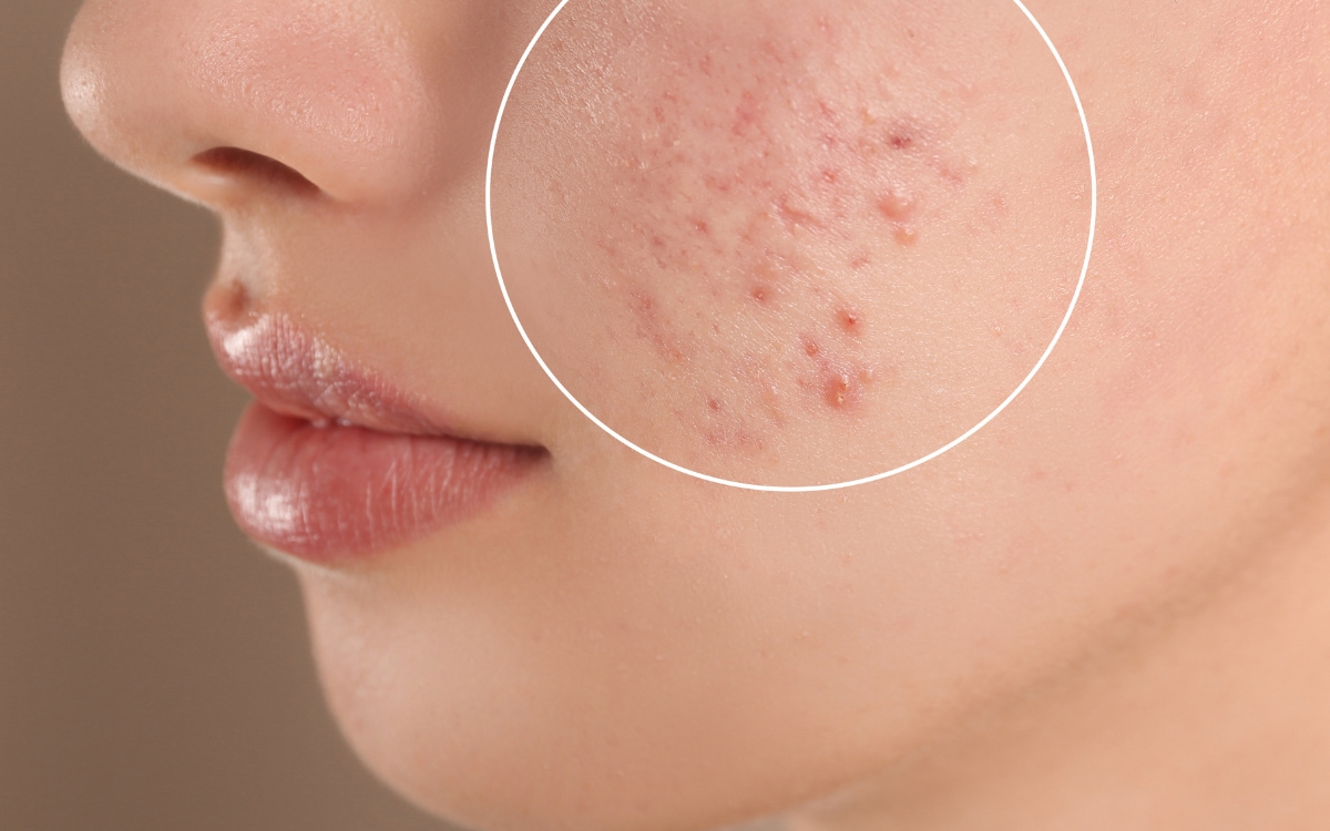 Addio all'Acne! Combatti l'acne da dentro con i Migliori Integratori ...